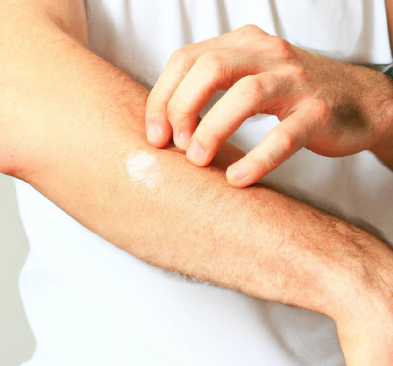 CBD Topical for Skin Ulcers: Clinical Trial Confirmed What We Have ...